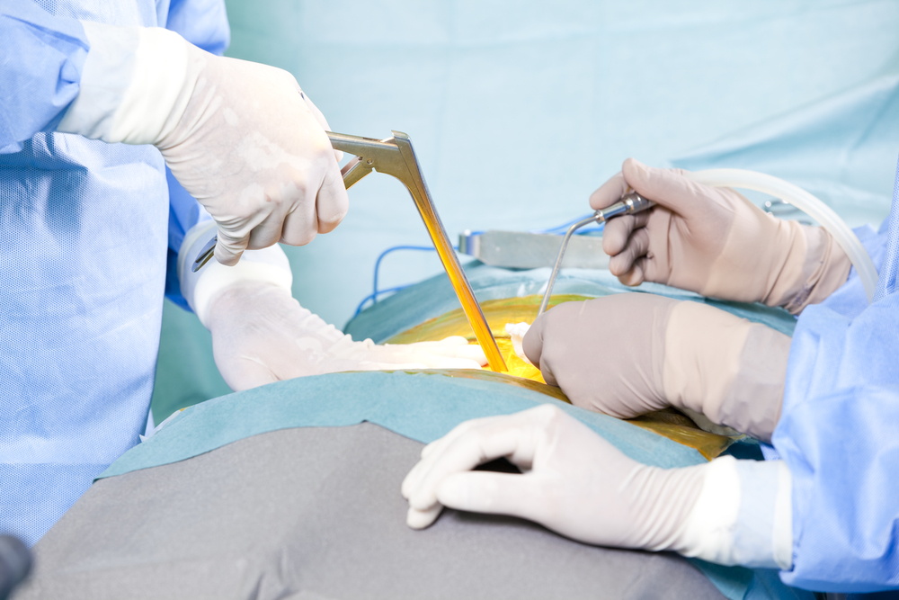 Laminektomija - AKSIS Specijalna bolnica