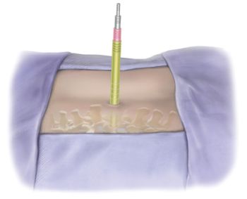 METRx micro-endoscopic spine surgery - AKSIS Special Hospital