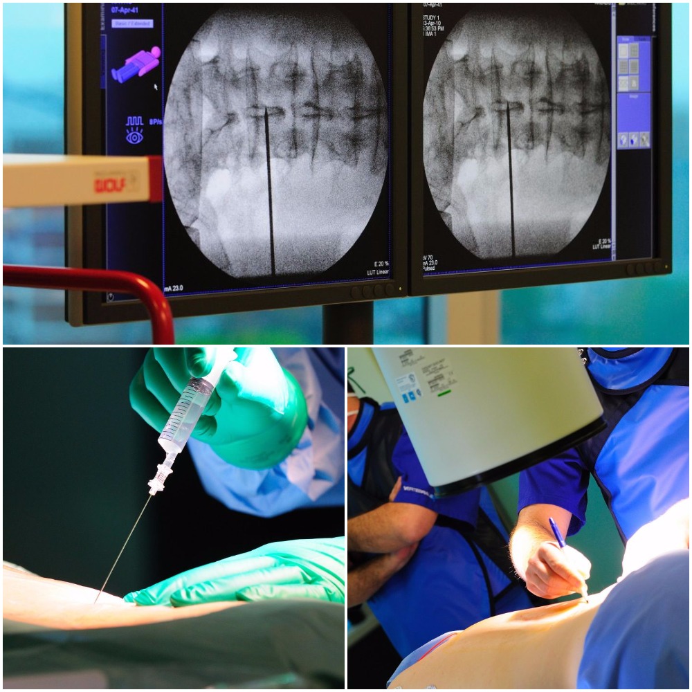 Spinal Ozone Therapy - AKSIS Special Hospital